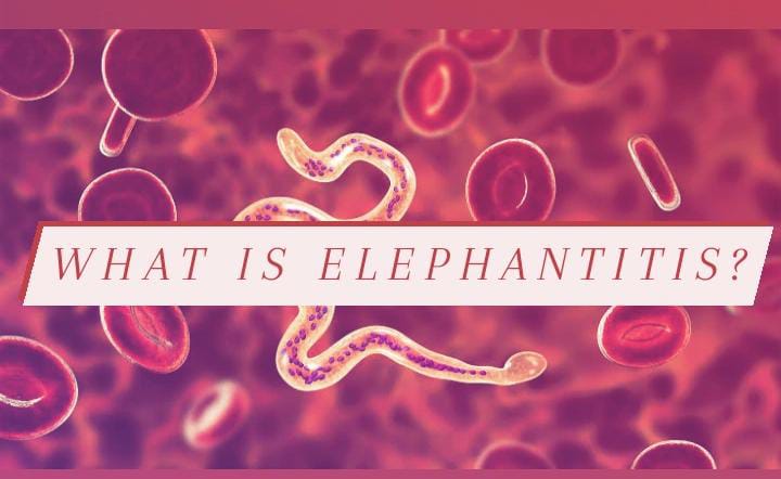 Elephantitis RiTricks: Elephantiasis